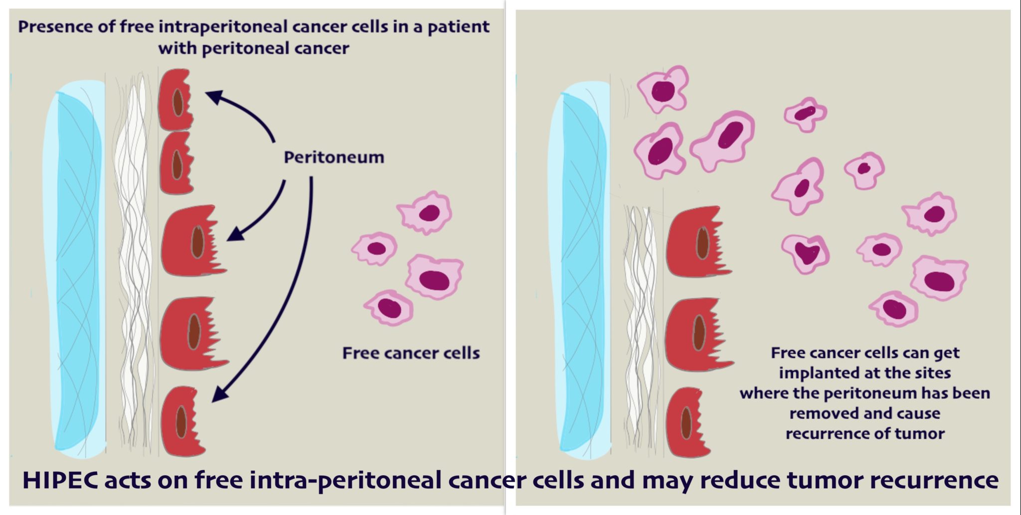 HIPEC Cancer Surgery in Ahmedabad | Top Specialist -Dr Aditi